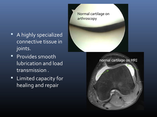 Cartilage imaging simplified | PPT
