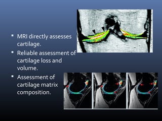 Cartilage imaging simplified | PPT