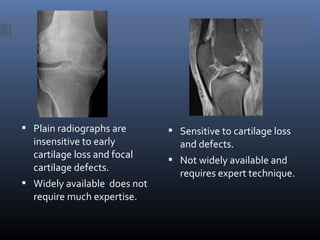 Cartilage imaging simplified | PPT