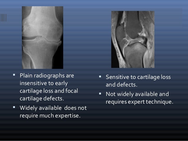 Cartilage imaging simplified
