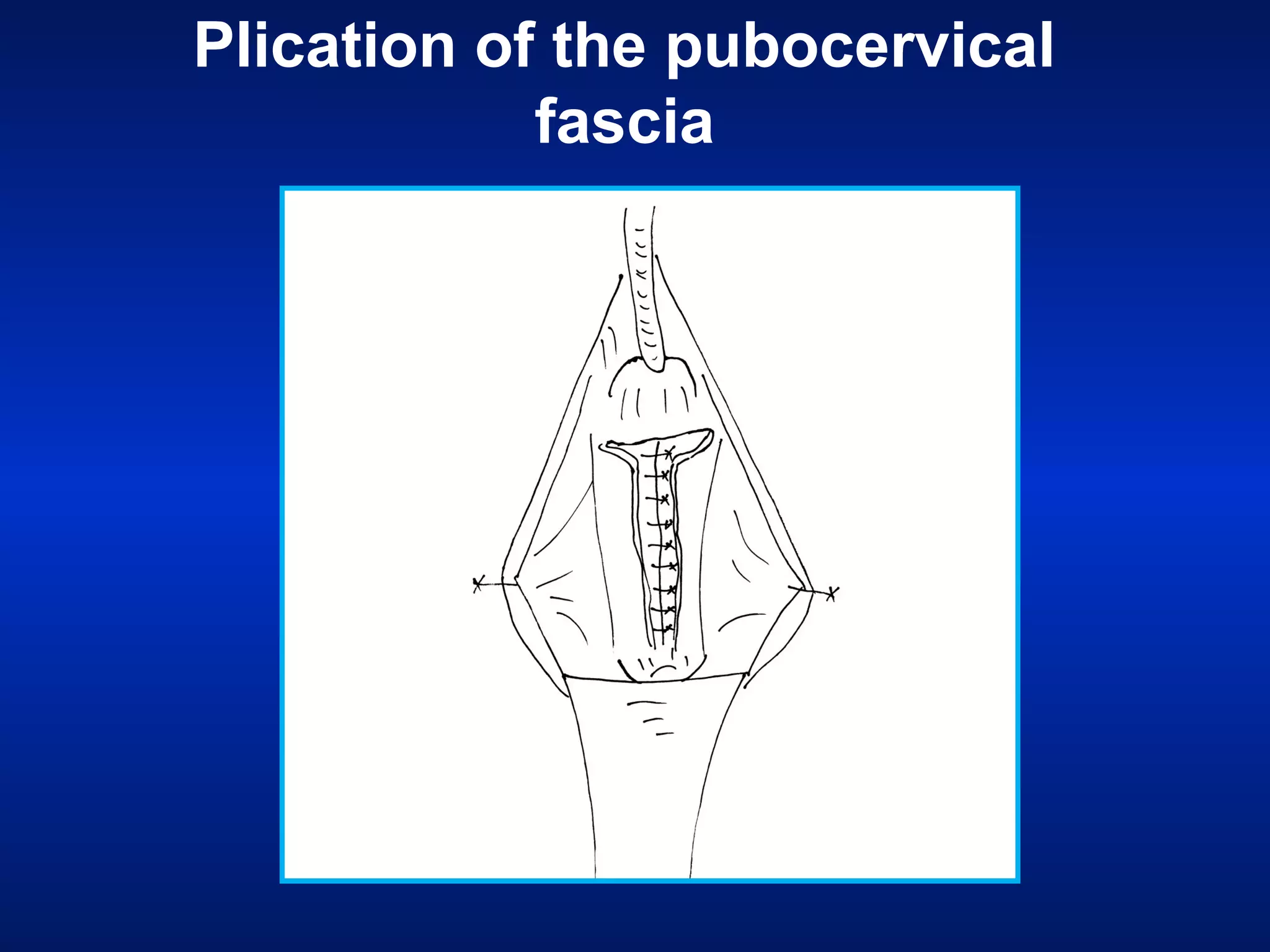 Modified extended anterior vaginal wall repair for cystocele | PPT