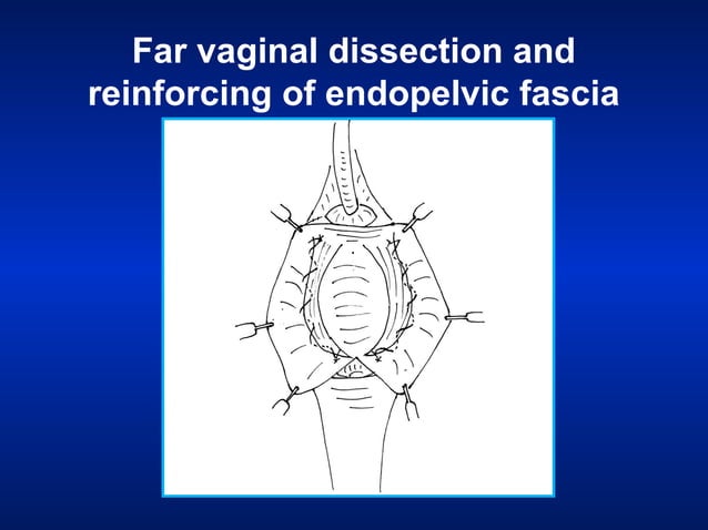 Modified extended anterior vaginal wall repair for cystocele | PPT