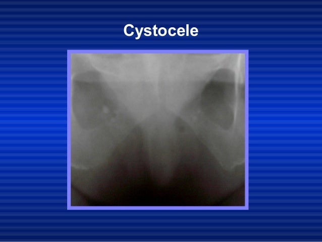 Modified extended anterior vaginal wall repair for cystocele