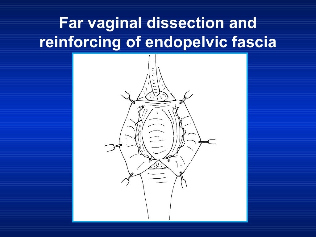 Modified extended anterior vaginal wall repair for cystocele