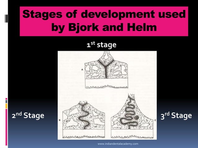 Modified hyrex expander for correction of upper mid line deviation ...