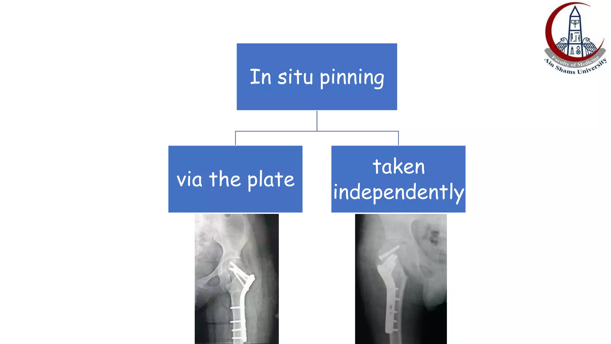 Modified imhauser osteotomy | PPTX