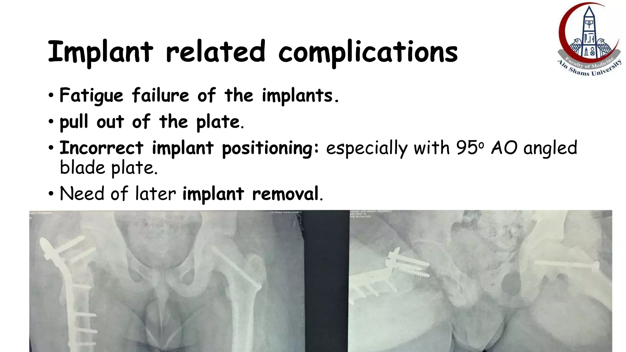 Modified imhauser osteotomy | PPTX