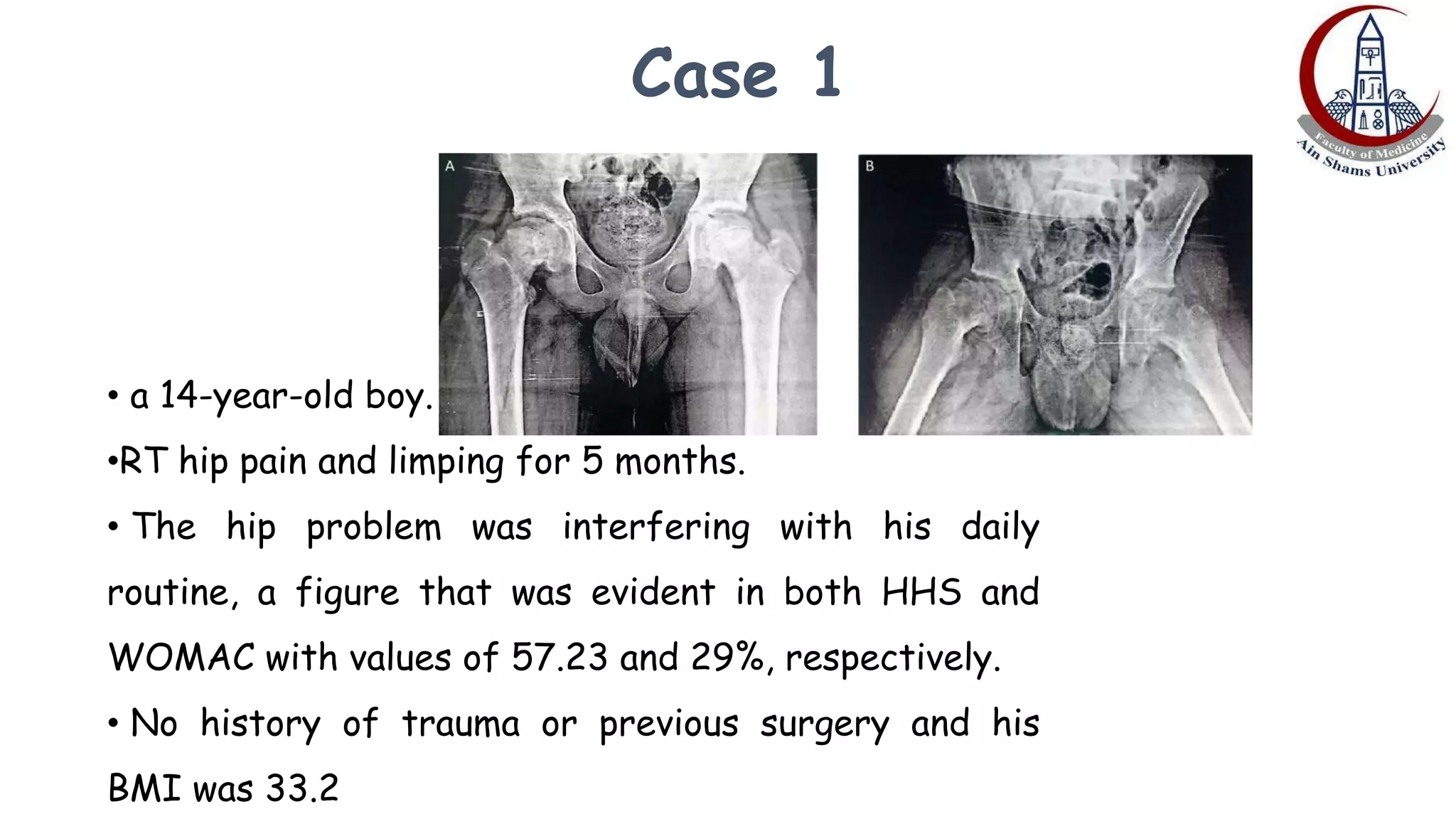 Modified imhauser osteotomy | PPTX