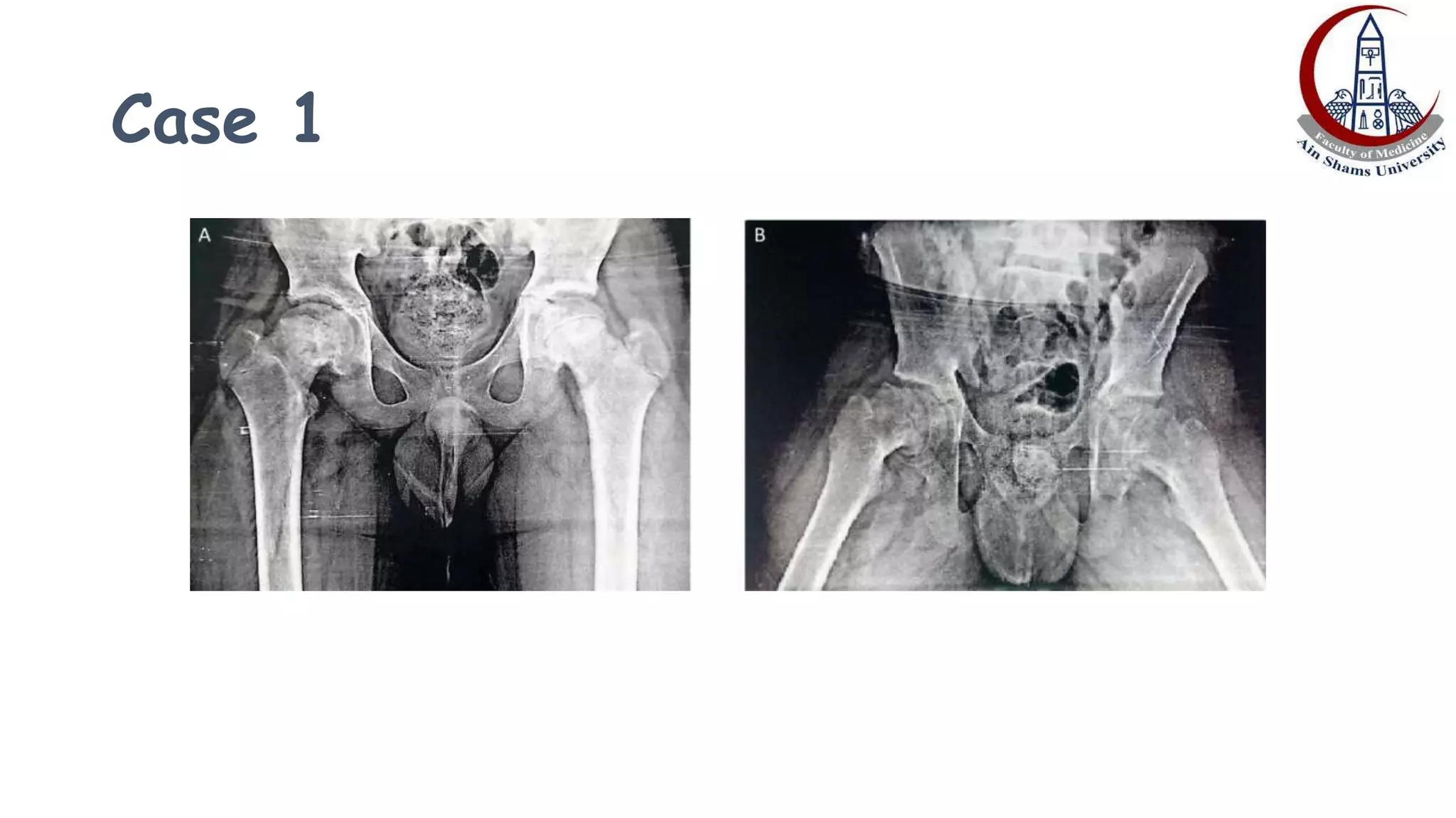 Modified imhauser osteotomy | PPTX