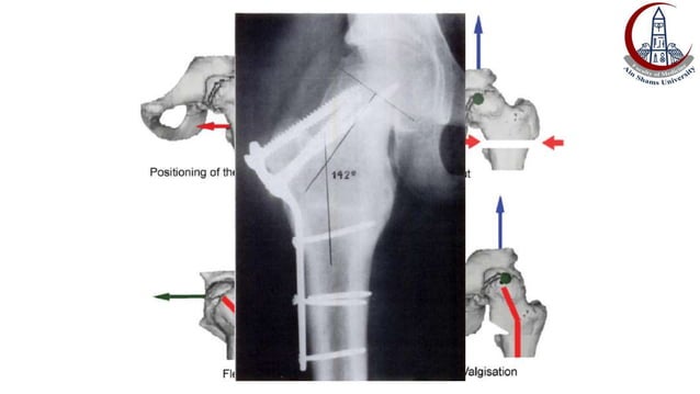 Modified imhauser osteotomy | PPTX