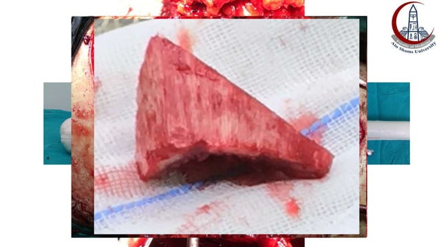 Modified imhauser osteotomy | PPTX