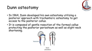 Modified imhauser osteotomy | PPTX