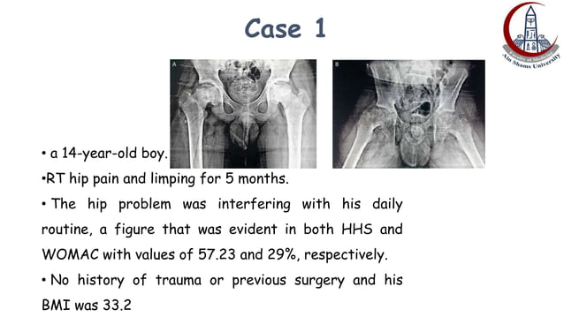 Modified imhauser osteotomy | PPTX