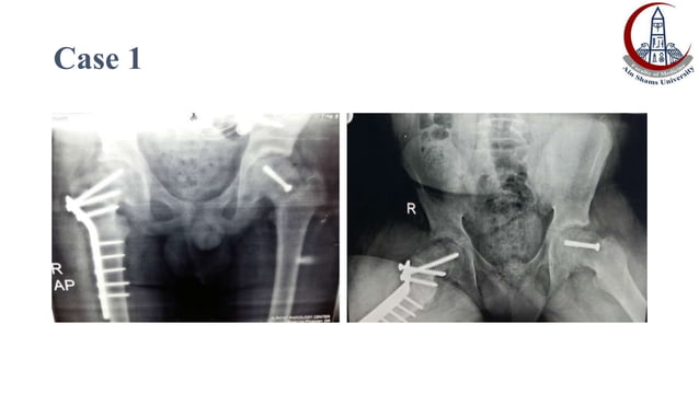 Modified imhauser osteotomy | PPTX