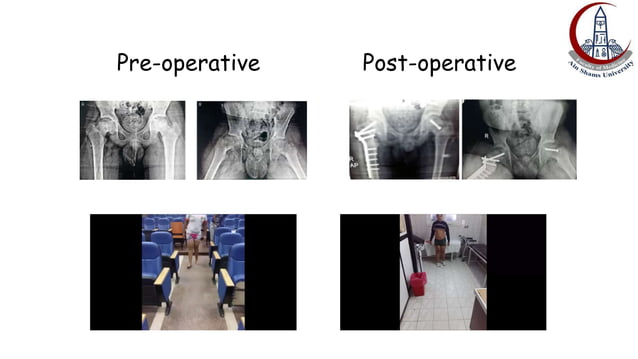 Modified imhauser osteotomy | PPTX