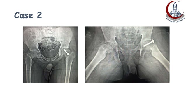 Modified imhauser osteotomy | PPT