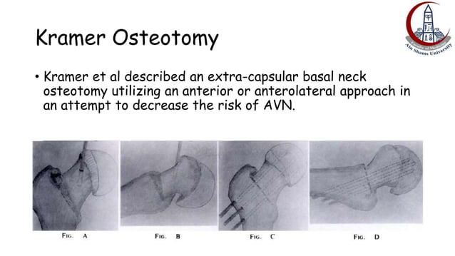 Modified imhauser osteotomy | PPTX