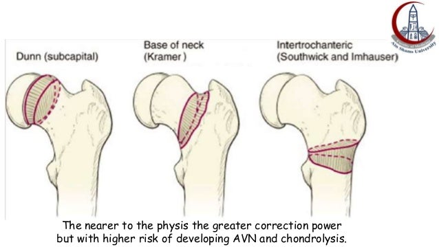 Modified imhauser osteotomy