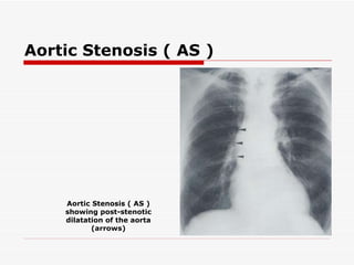 Aortic Stenosis X Ray