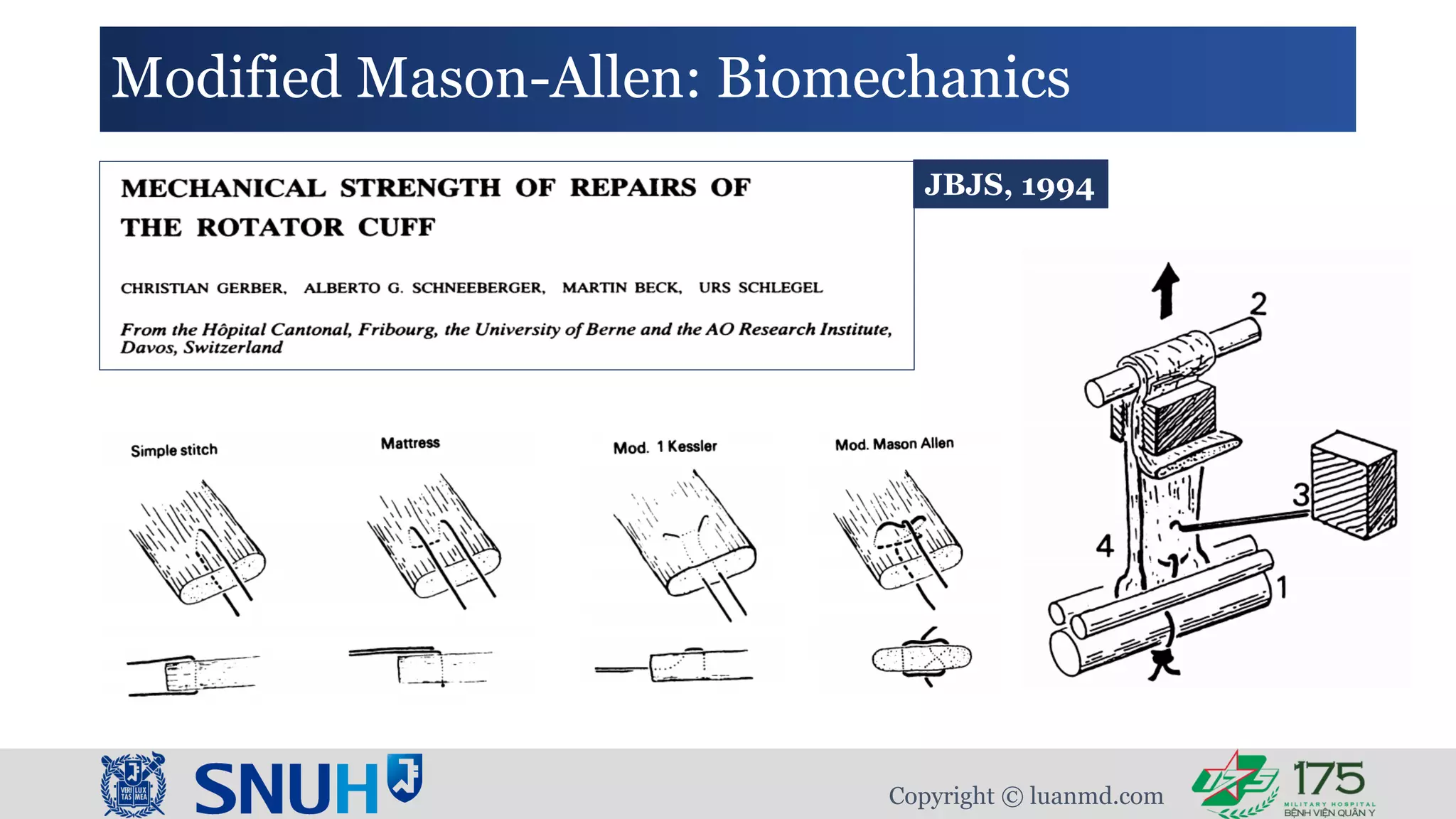 Modified Mason-Allen Technique For Rotator Cuff Repair | PDF