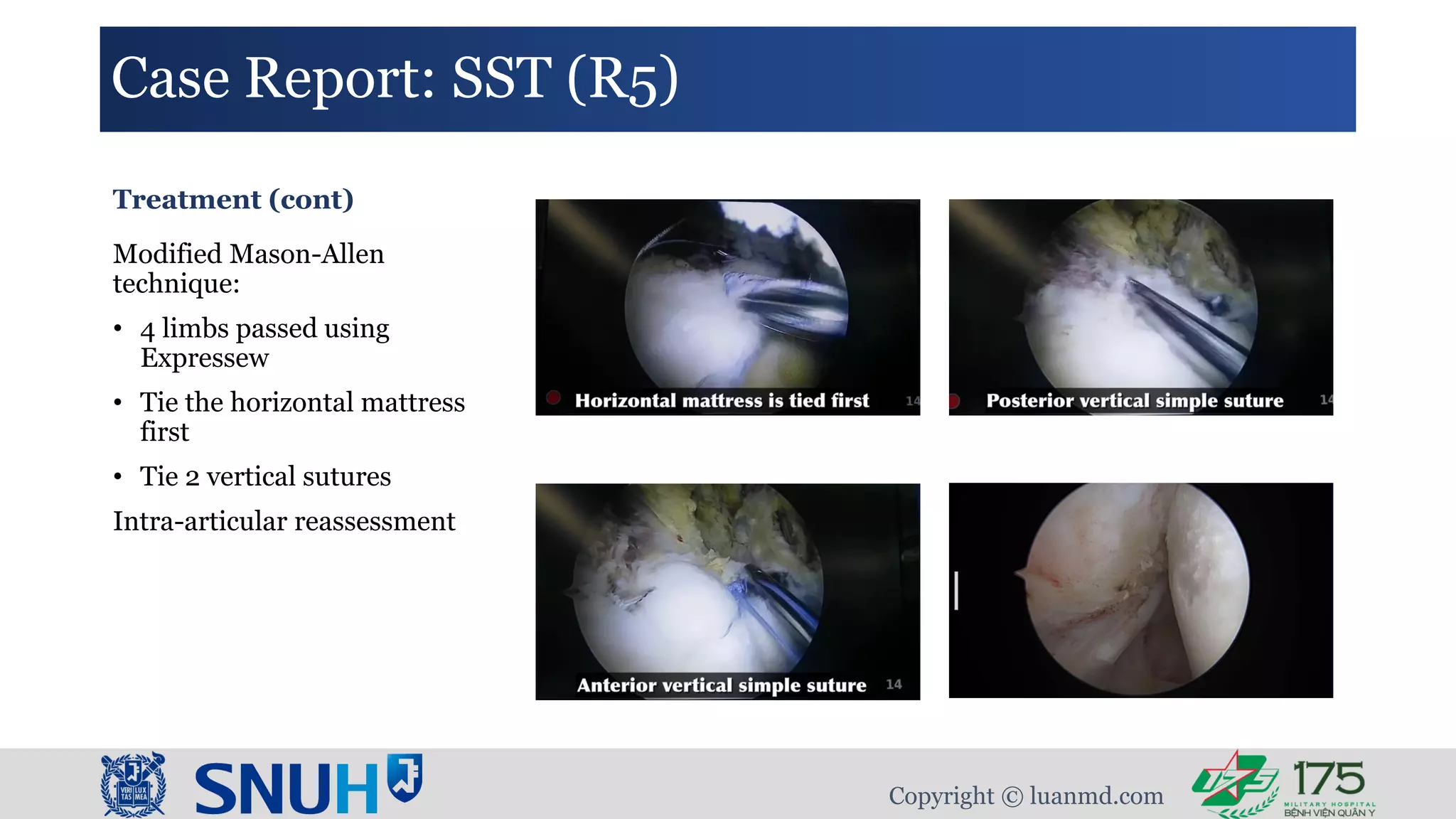 Modified Mason-Allen Technique For Rotator Cuff Repair | PDF