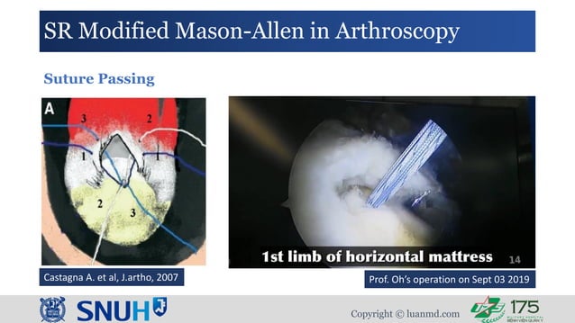Modified Mason-Allen Technique For Rotator Cuff Repair | PDF | Death ...