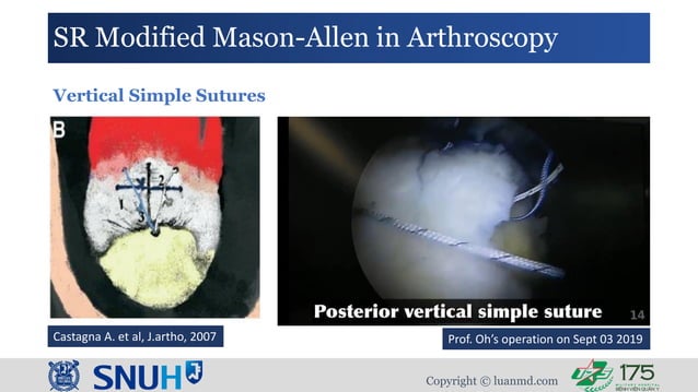 Modified Mason-Allen Technique For Rotator Cuff Repair | PDF | Death ...
