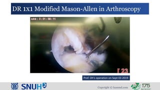 Modified Mason-Allen Technique For Rotator Cuff Repair | PDF