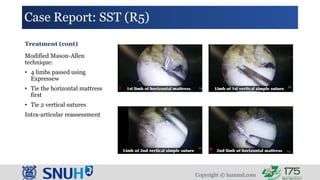 Modified Mason-Allen Technique For Rotator Cuff Repair | PDF