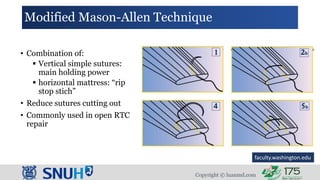 Modified Mason-Allen Technique For Rotator Cuff Repair | PPT