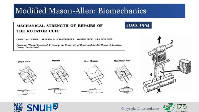 Modified Mason-Allen Technique For Rotator Cuff Repair