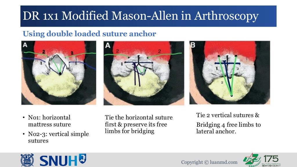 Modified Mason-Allen Technique For Rotator Cuff Repair