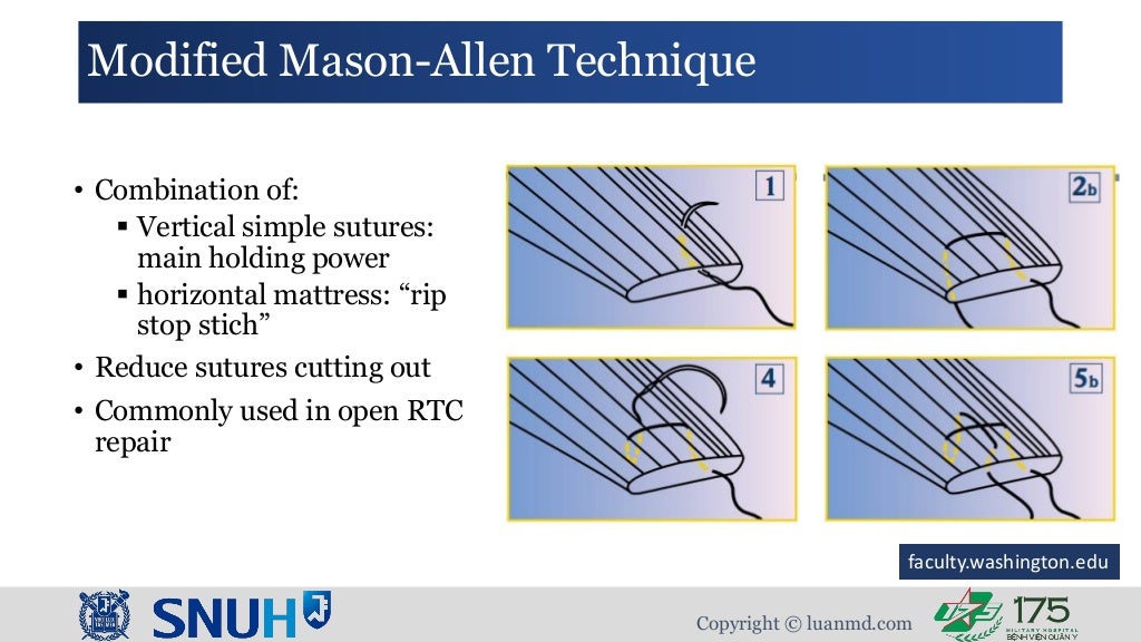 Modified Mason-Allen Technique For Rotator Cuff Repair