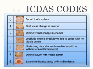 Modified moh icdas system for early caries | PPTX