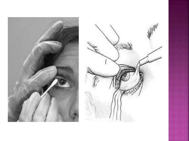 instillation and irrigation of eye,ear.nose | Eye and Vision Conditions ...