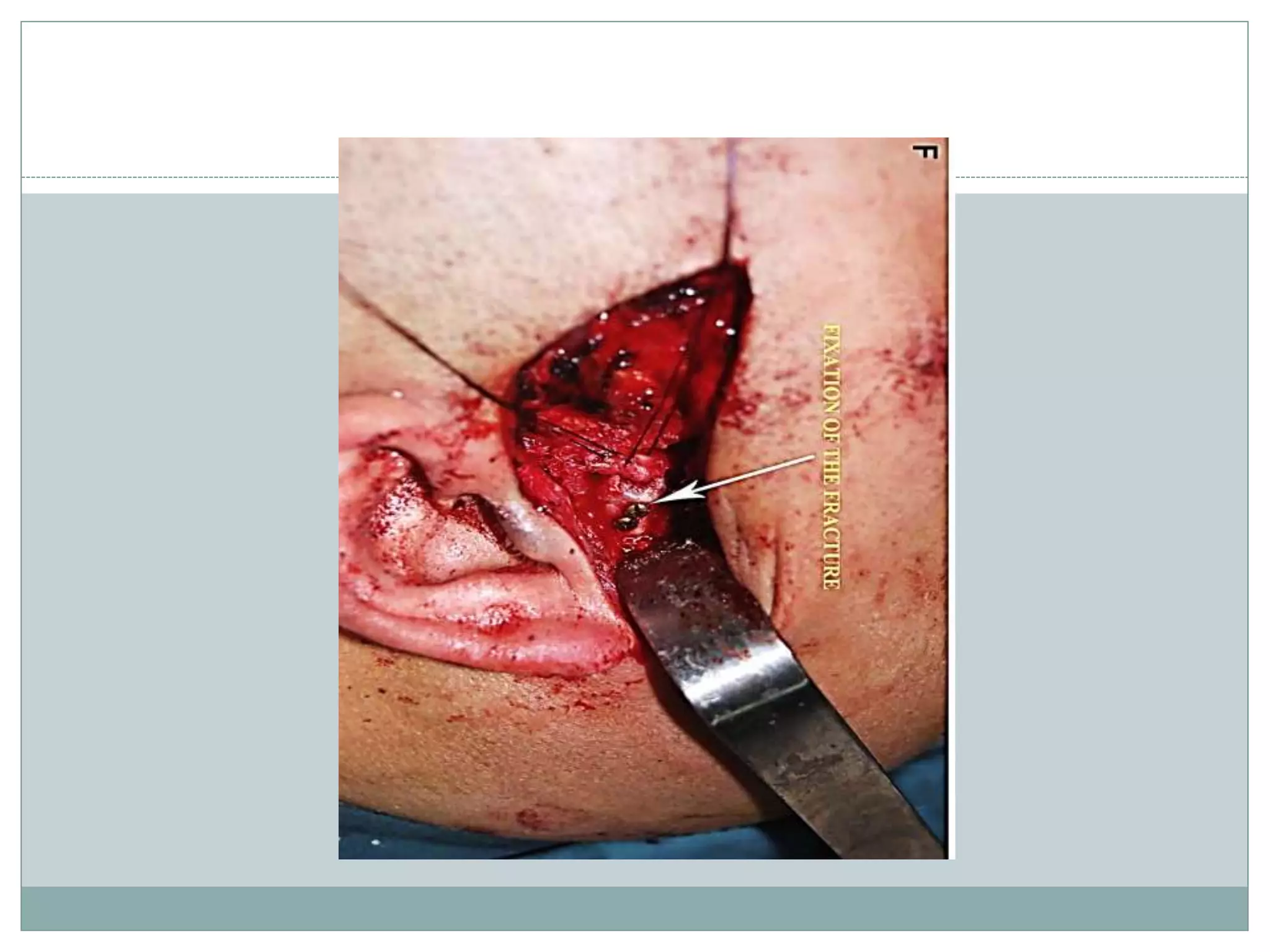 Modified preauricular approach for treating intracapsular condylar ...