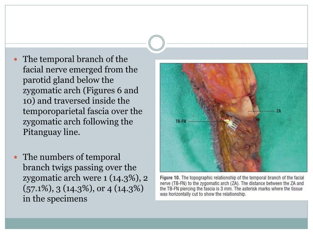 Modified preauricular approach for treating intracapsular condylar ...