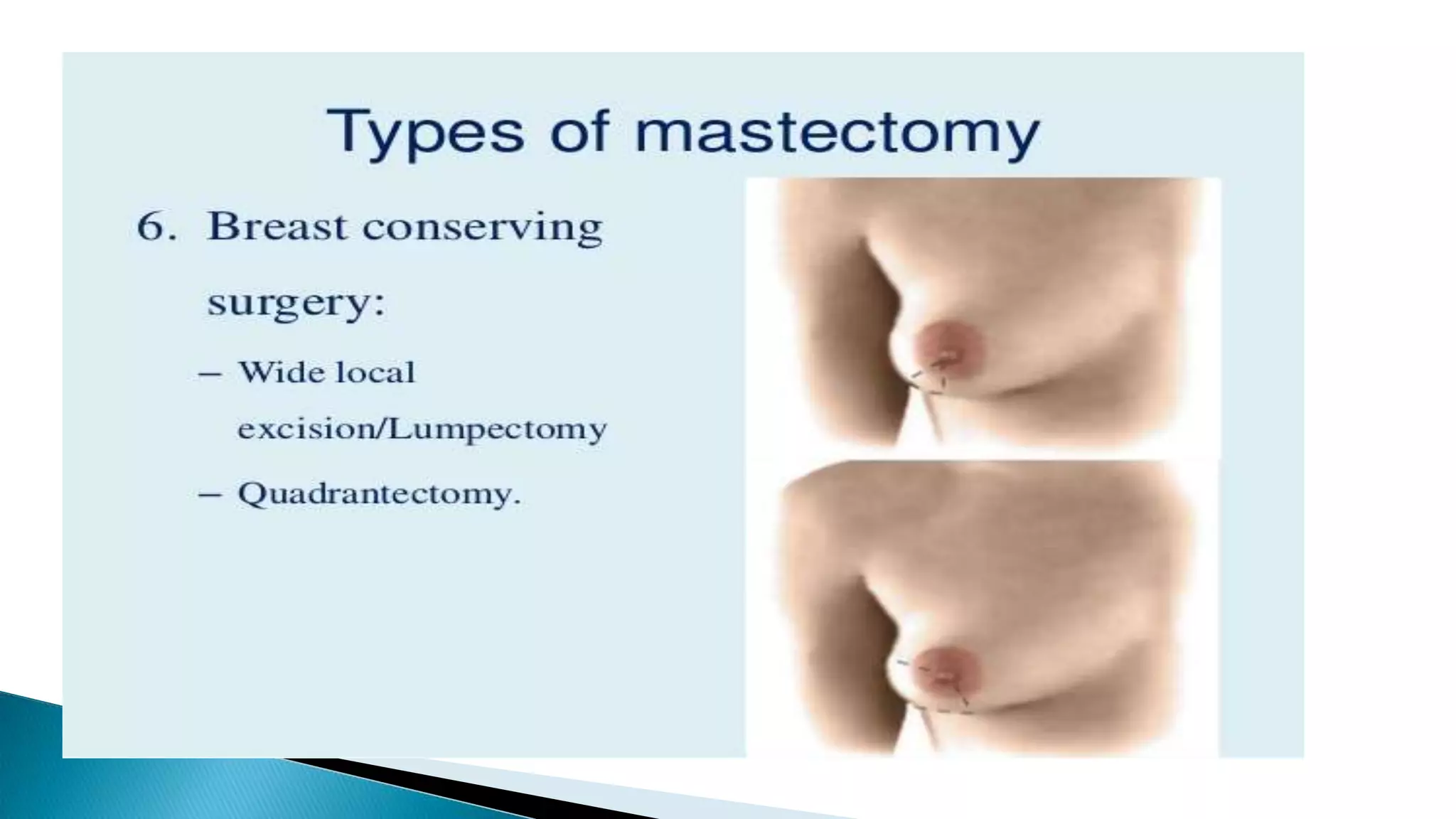 Modified radical mastectomy | PPTX
