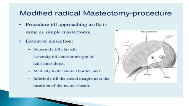 Modified radical mastectomy | PPTX