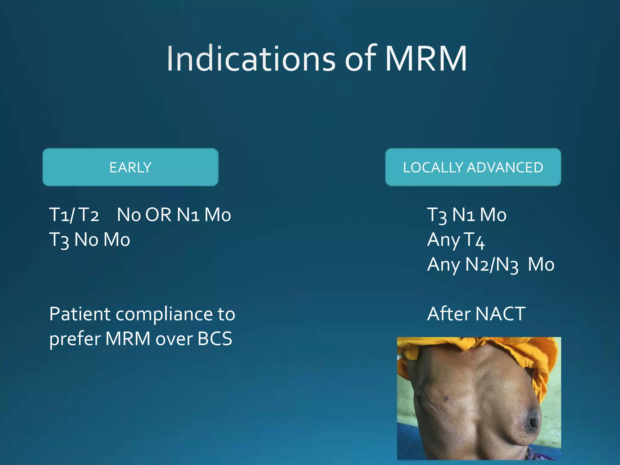 Modified radical mastectomy | PPTX