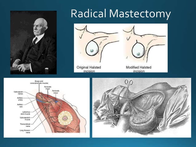 Modified Radical Mastectomy