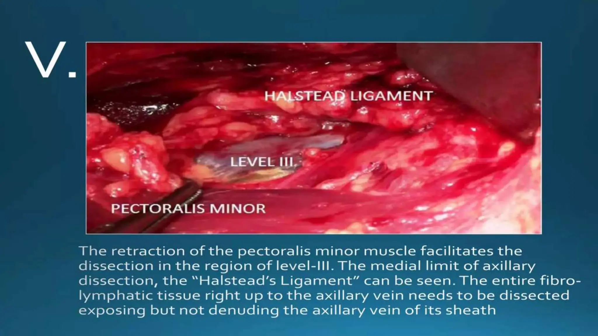 MODIFIED RADICAL MASTECTOMY-OPERATIVE PROCEDURE.pptx