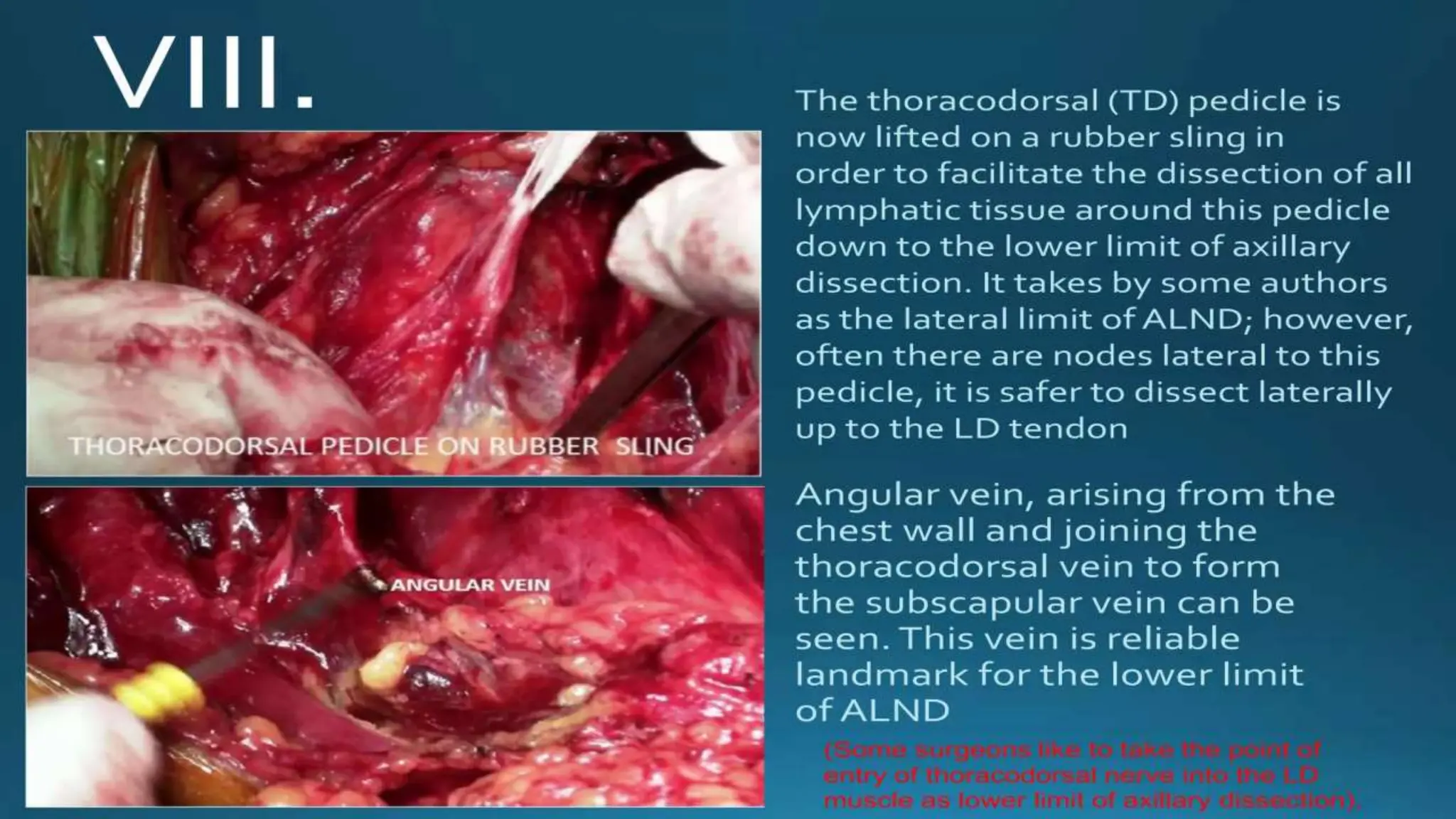 MODIFIED RADICAL MASTECTOMY-OPERATIVE PROCEDURE.pptx