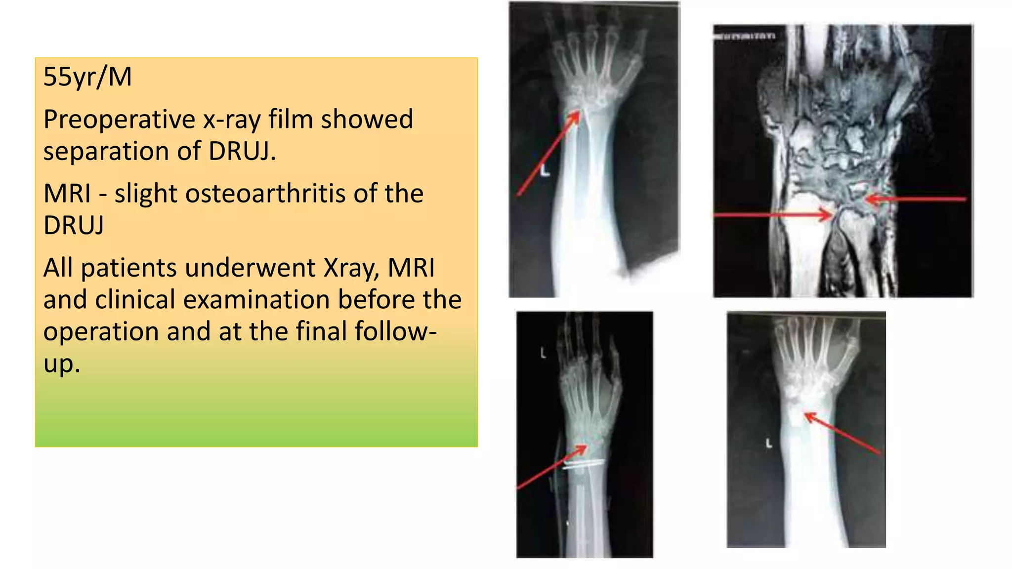Modified sauve kapandji procedure for patients with old fractures | PPTX