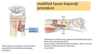 Modified sauve kapandji procedure for patients with old fractures | PPTX