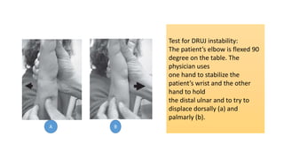 Modified sauve kapandji procedure for patients with old fractures | PPTX