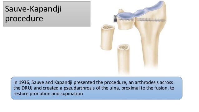Modified sauve kapandji procedure for patients with old fractures