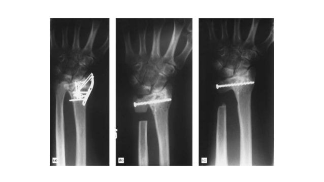 Modified sauve kapandji procedure for patients with old fractures