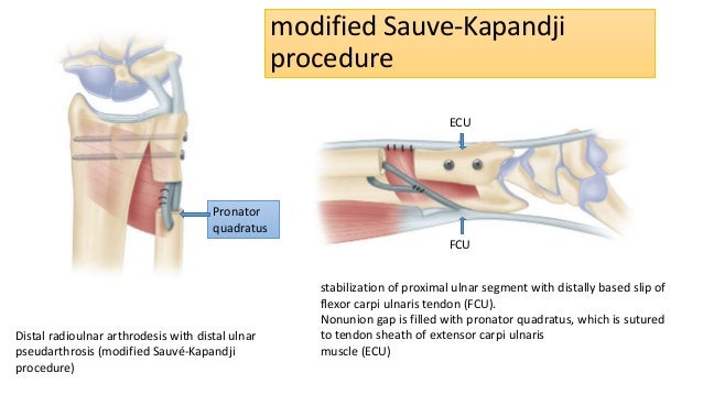 Modified sauve kapandji procedure for patients with old fractures