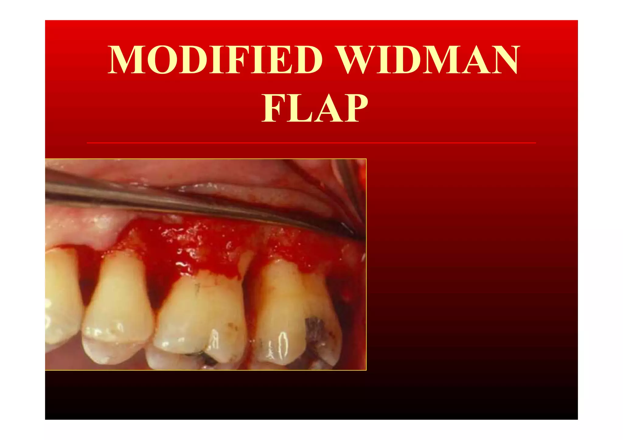 Modified widman flap | PDF